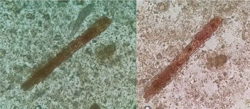 Urine Sediment of the Month: Pigmented Casts & What Those Pretty Colors ...