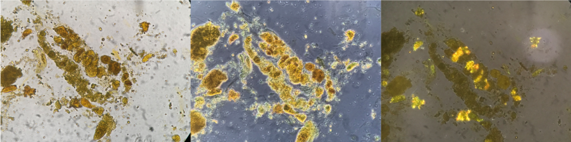 Urine Sediment of the Month: Pigmented Casts & What Those Pretty Colors ...
