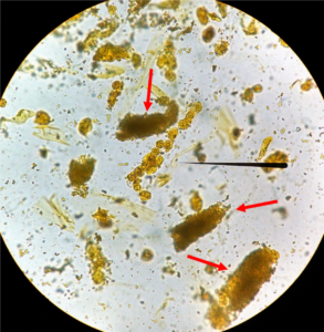 Urine Sediment of the Month: Pigmented Casts & What Those Pretty Colors ...