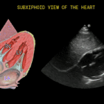 Focused Cardiac Ultrasound for the Nephrologist: The Subxiphoid View ...