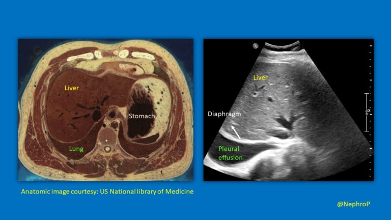 Focused Cardiac Ultrasound for the Nephrologist: The Subxiphoid View ...