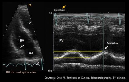Focused Cardiac Ultrasound for the Nephrologist: Utility of the M-mode ...