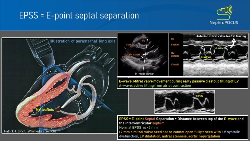 Focused Cardiac Ultrasound for the Nephrologist: Utility of the M-mode ...