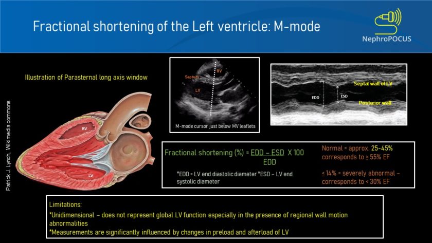 Focused Cardiac Ultrasound for the Nephrologist: Utility of the M-mode ...
