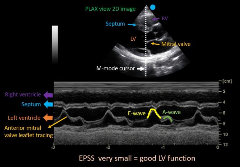 Focused Cardiac Ultrasound for the Nephrologist: Utility of the M-mode ...