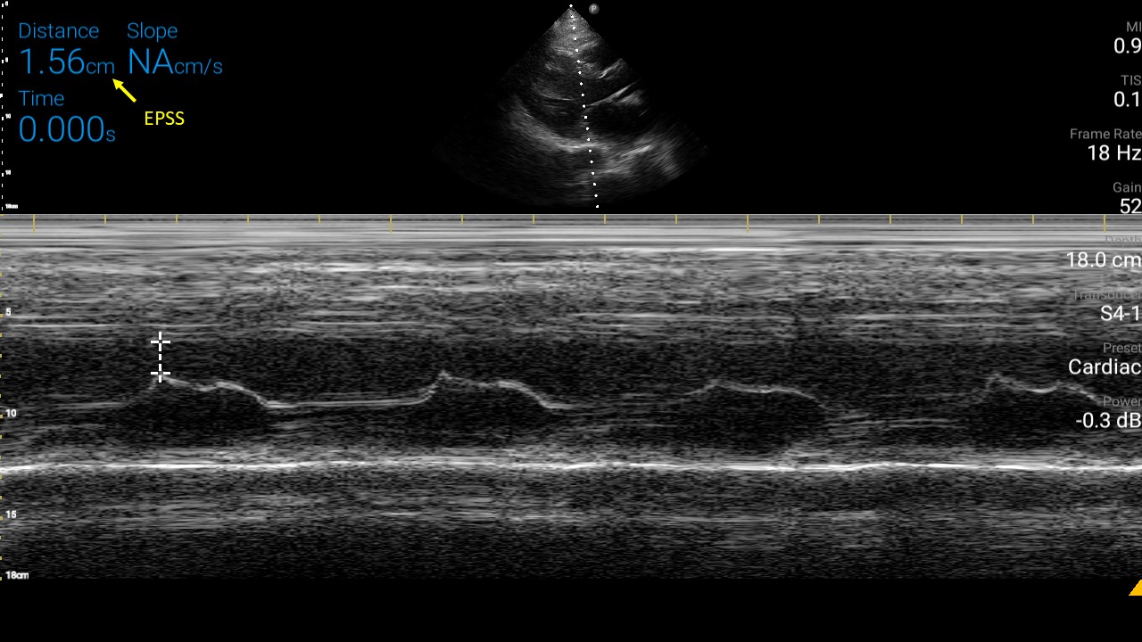 Focused Cardiac Ultrasound for the Nephrologist: Utility of the M-mode ...
