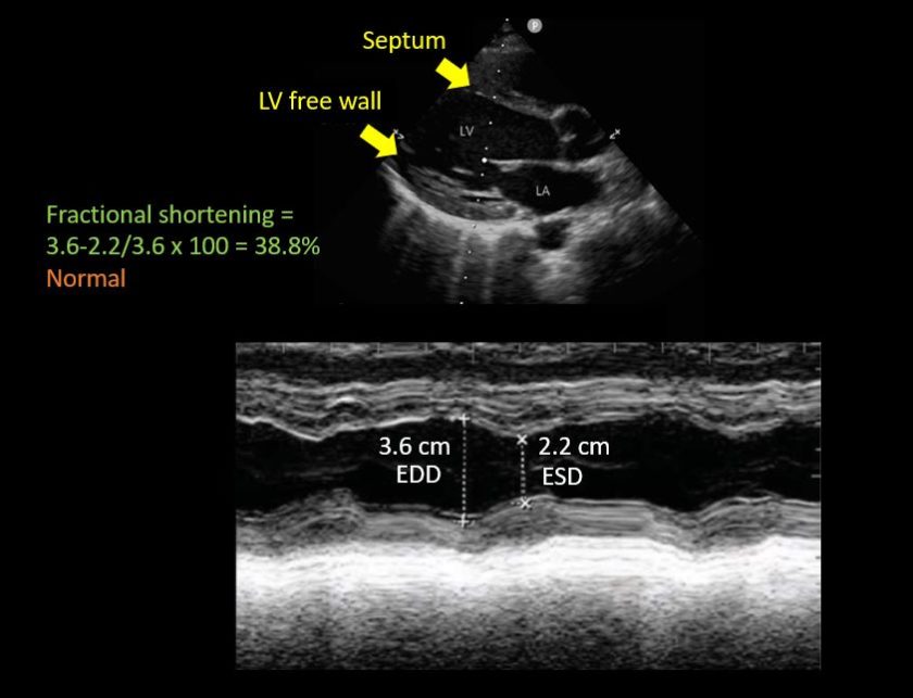 Focused Cardiac Ultrasound for the Nephrologist: Utility of the M-mode ...