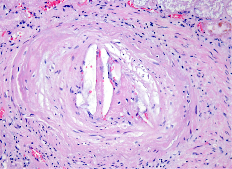 Kidney Biopsy of the Month: Atheroembolic Kidney Disease - Renal Fellow ...