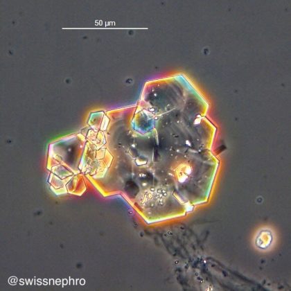 Urine Sediment of the Month: Cystine Crystals - Renal Fellow Network