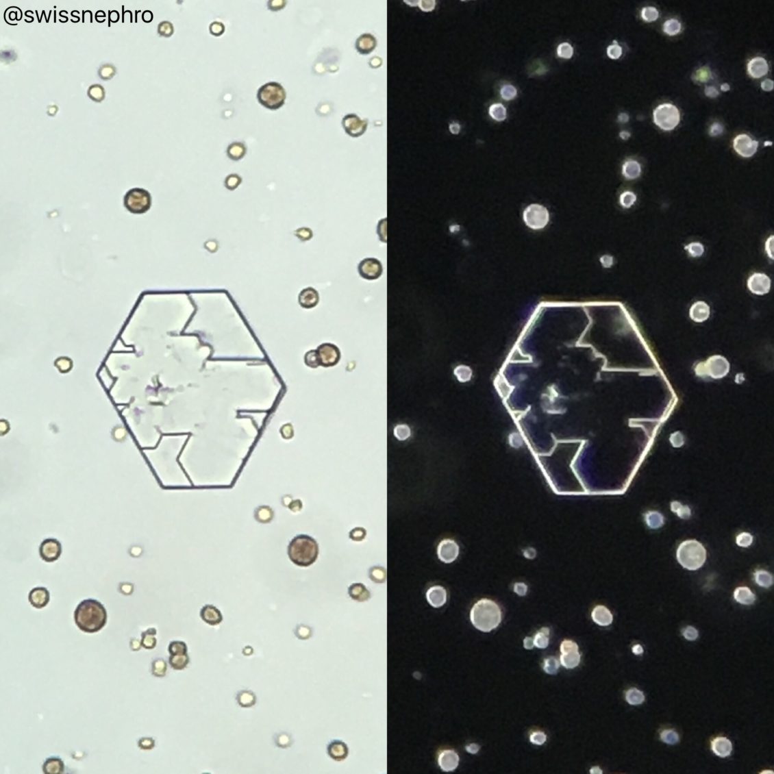 Urine Sediment of the Month: Cystine Crystals - Renal Fellow Network