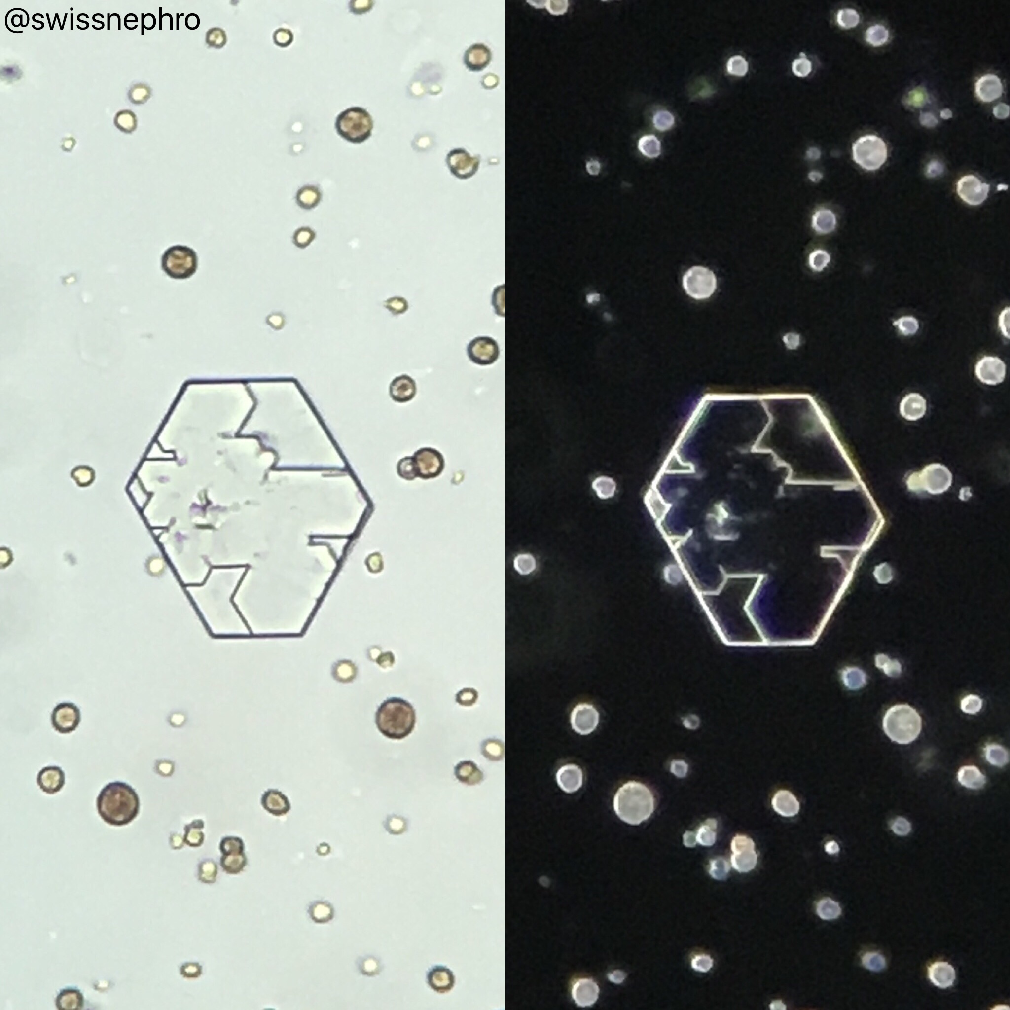 Urine Sediment of the Month: Cystine Crystals - Renal Fellow Network