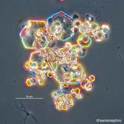 Urine Sediment of the Month: Cystine Crystals - Renal Fellow Network