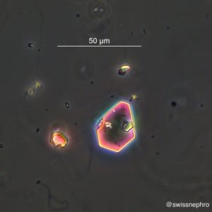 Urine Sediment of the Month: Cystine Crystals - Renal Fellow Network
