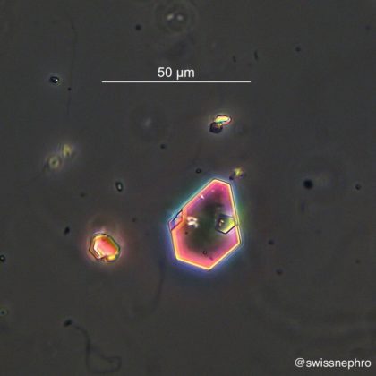 Urine Sediment of the Month: Cystine Crystals - Renal Fellow Network