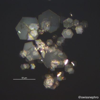 Urine Sediment of the Month: Cystine Crystals - Renal Fellow Network