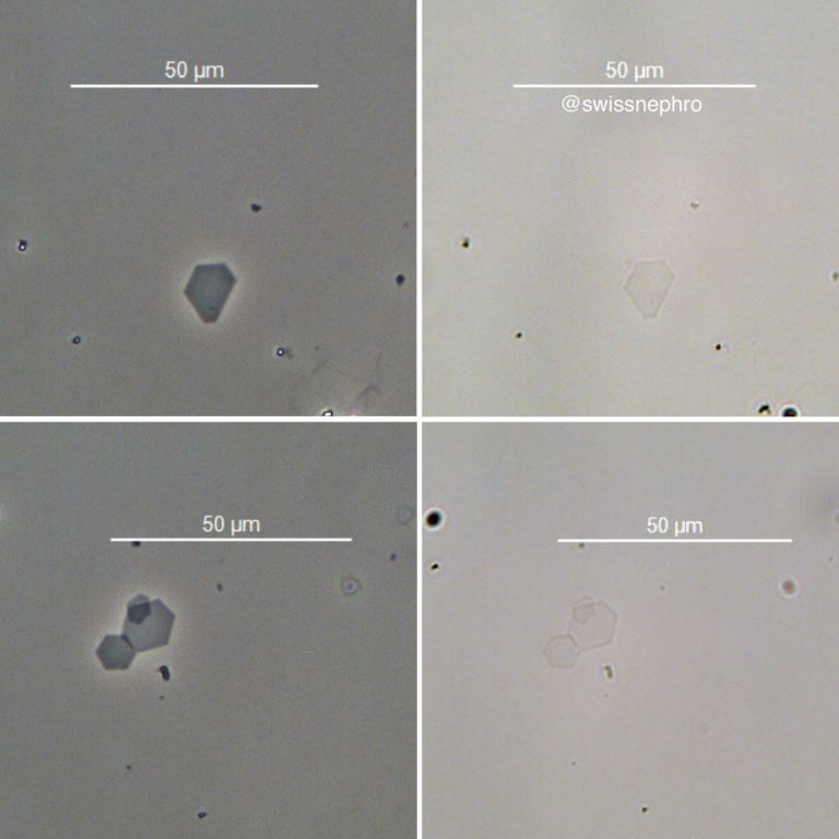 Urine Sediment of the Month: Cystine Crystals - Renal Fellow Network