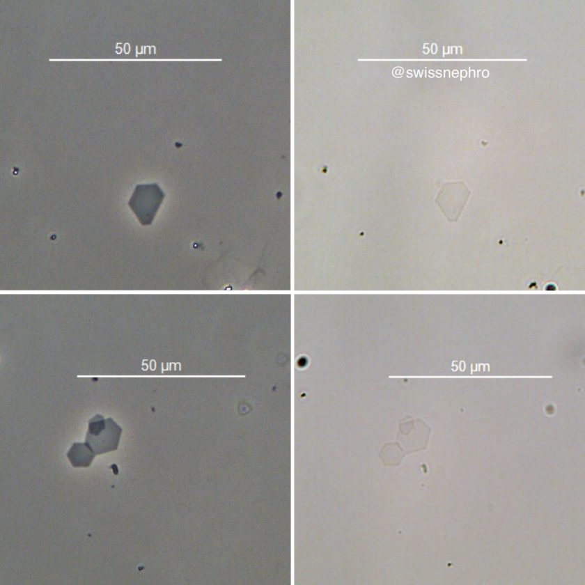 Urine Sediment of the Month: Cystine Crystals - Renal Fellow Network