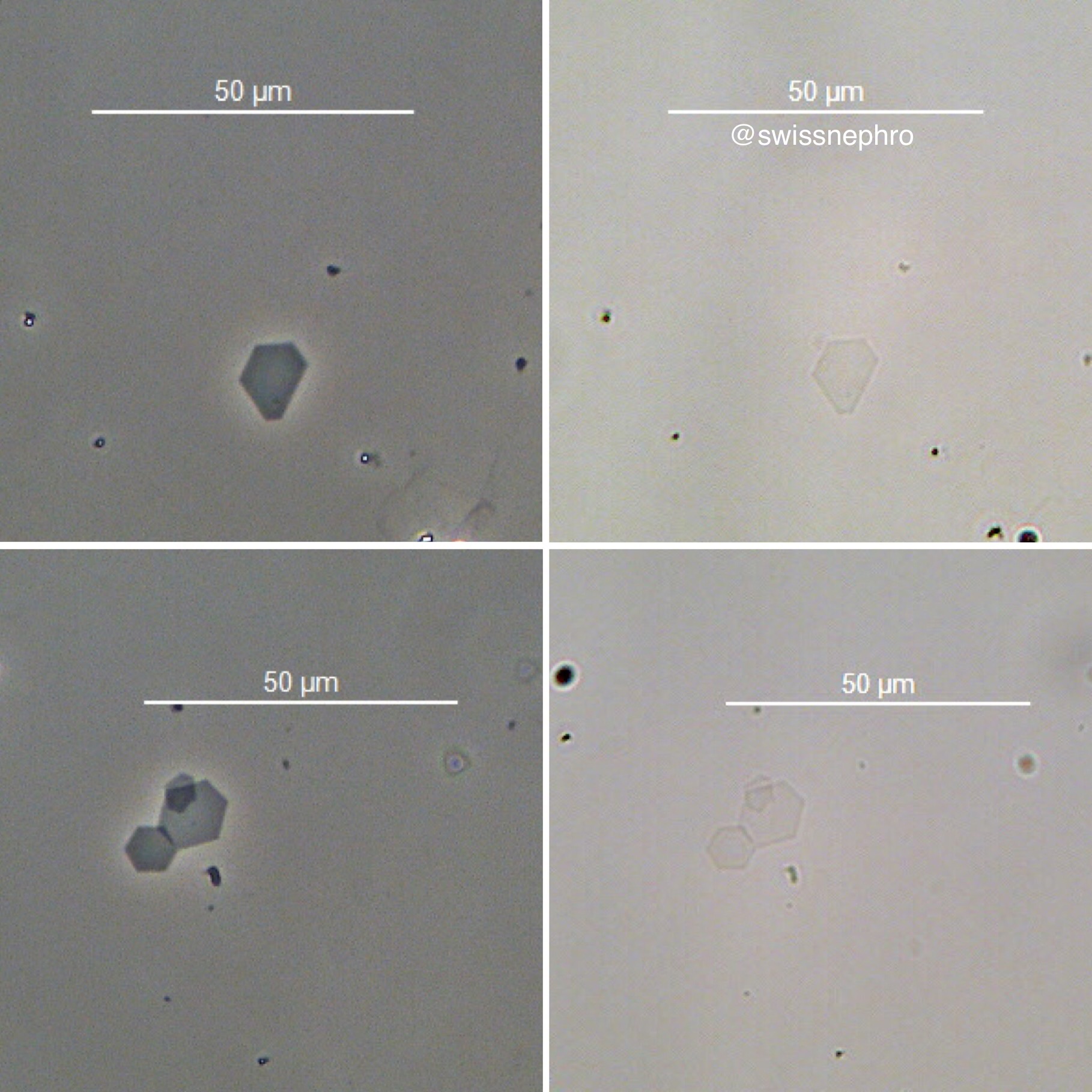 Urine Sediment of the Month: Cystine Crystals - Renal Fellow Network