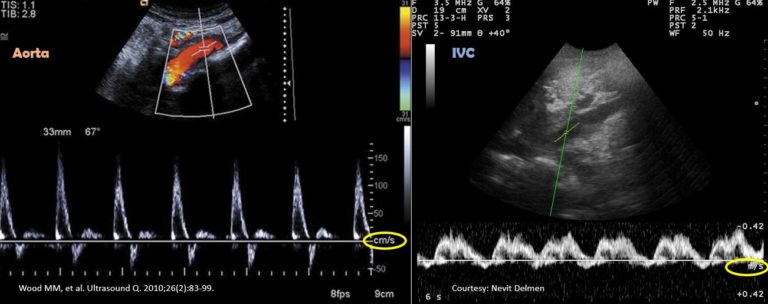 Inferior Vena Cava POCUS: The Basics of Image Acquisition - Renal ...