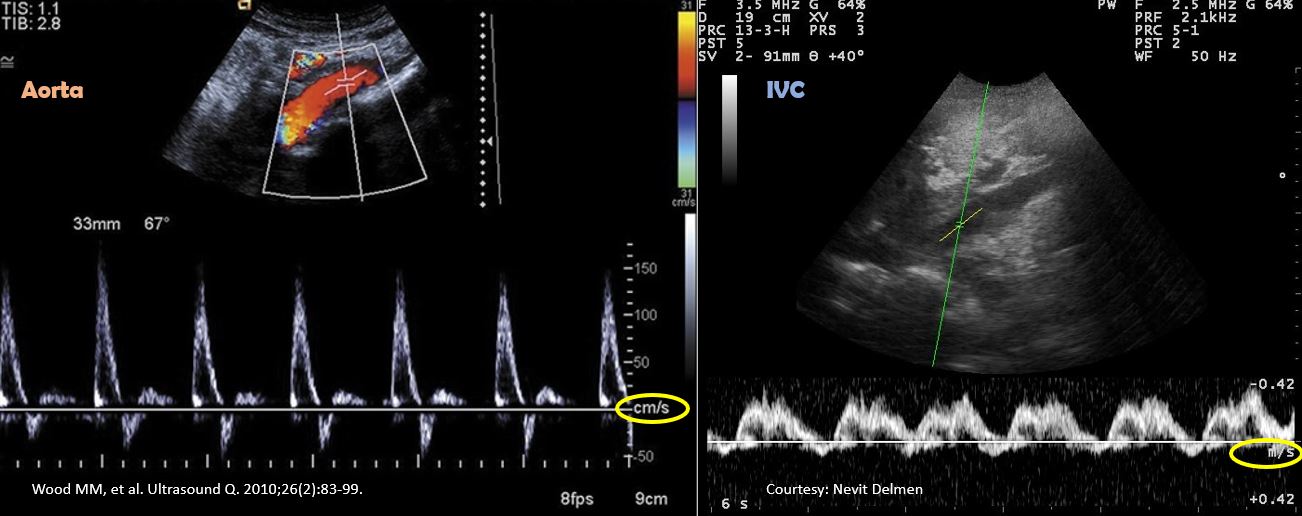Inferior Vena Cava POCUS: The Basics of Image Acquisition - Renal ...
