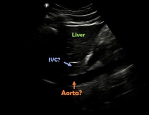 Inferior Vena Cava POCUS: The Basics of Image Acquisition - Renal ...