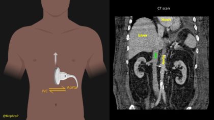 Inferior Vena Cava POCUS: The Basics of Image Acquisition - Renal ...