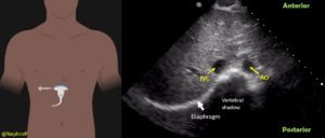 Inferior Vena Cava POCUS: The Basics of Image Acquisition - Renal ...
