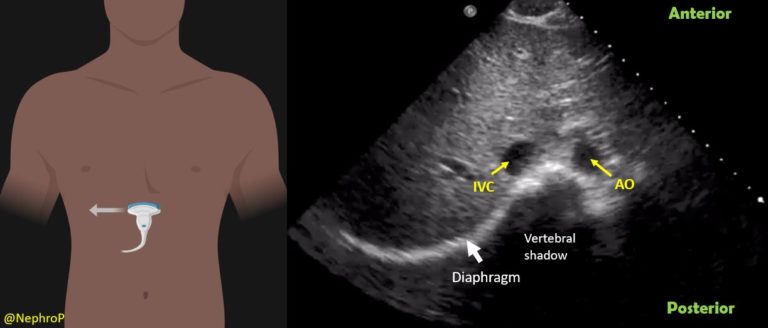 Inferior Vena Cava POCUS: The Basics of Image Acquisition - Renal ...