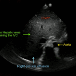 Inferior Vena Cava POCUS: The Basics of Image Acquisition - Renal ...
