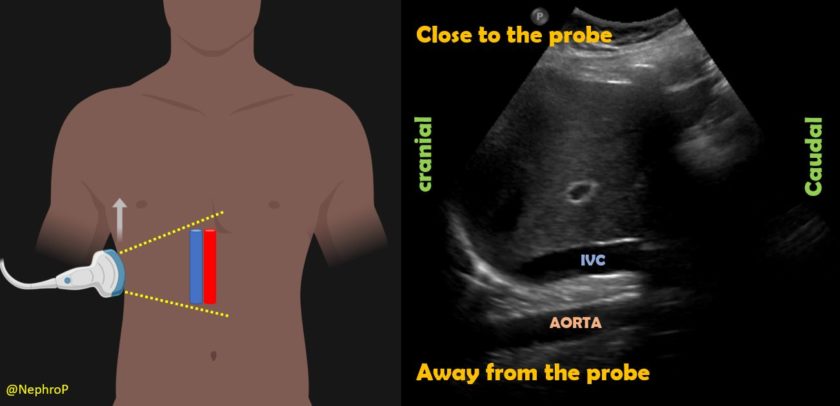 Inferior Vena Cava POCUS: The Basics of Image Acquisition - Renal ...