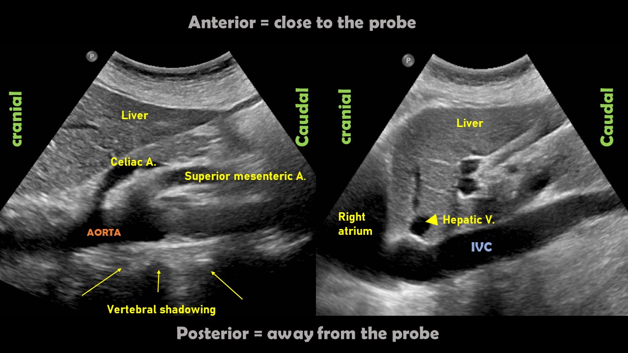 Inferior Vena Cava POCUS: The Basics of Image Acquisition - Renal ...