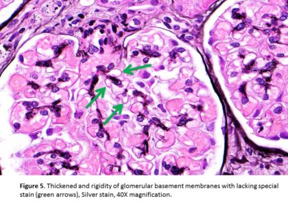Kidney Biopsy of the Month: Membranous Nephropathy - Renal Fellow Network