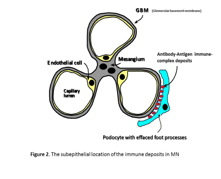 Kidney Biopsy of the Month: Membranous Nephropathy - Renal Fellow Network