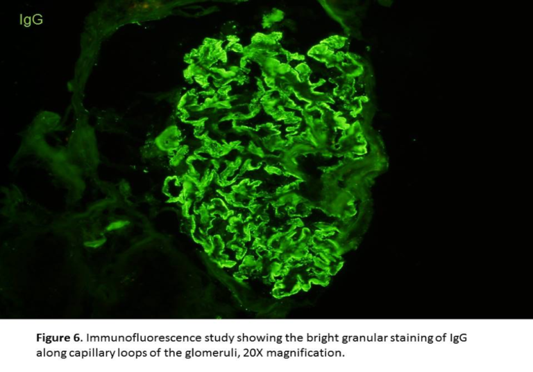 Kidney Biopsy of the Month: Membranous Nephropathy - Renal Fellow Network