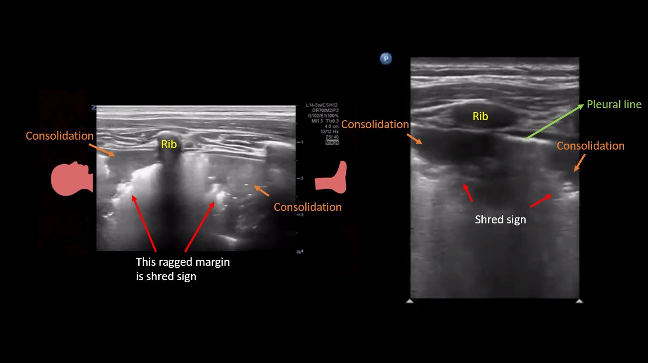 An Overview of Lung Ultrasound: The COVID edition part 2 - Renal Fellow ...