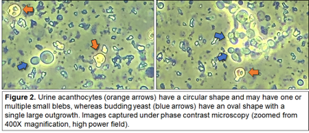 Urine Sediment of the Month: Dysmorphic Red Blood Cells, Blebs ...