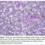 Urine Sediment of the Month: Dysmorphic Red Blood Cells, Blebs ...