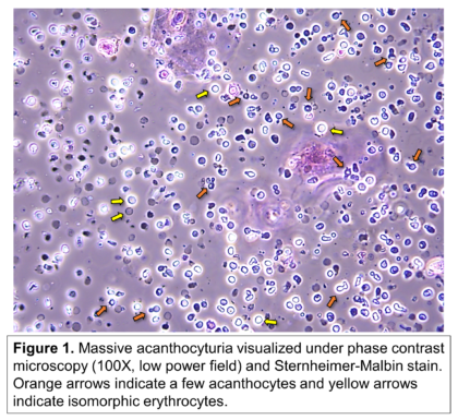 Urine Sediment of the Month: Dysmorphic Red Blood Cells, Blebs ...