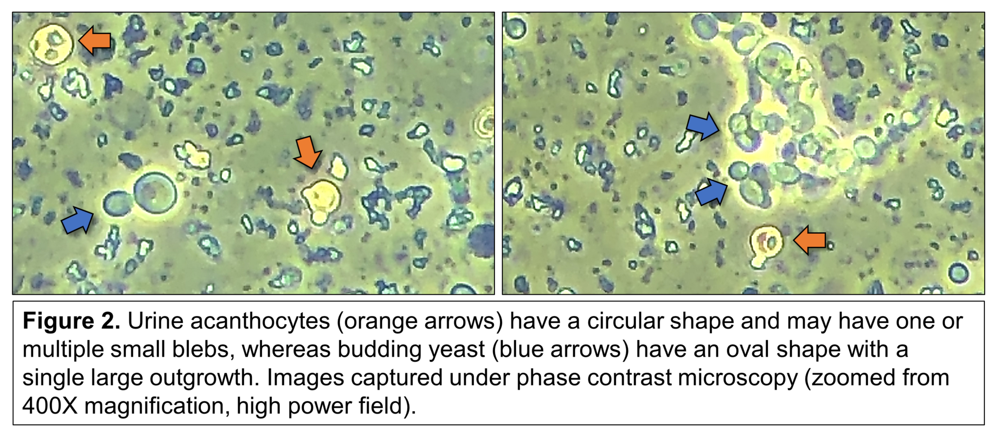 Urine Sediment of the Month: Dysmorphic Red Blood Cells, Blebs ...
