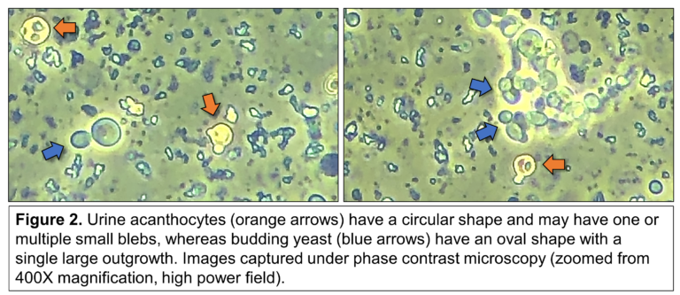 Urine Sediment of the Month: Dysmorphic Red Blood Cells, Blebs ...