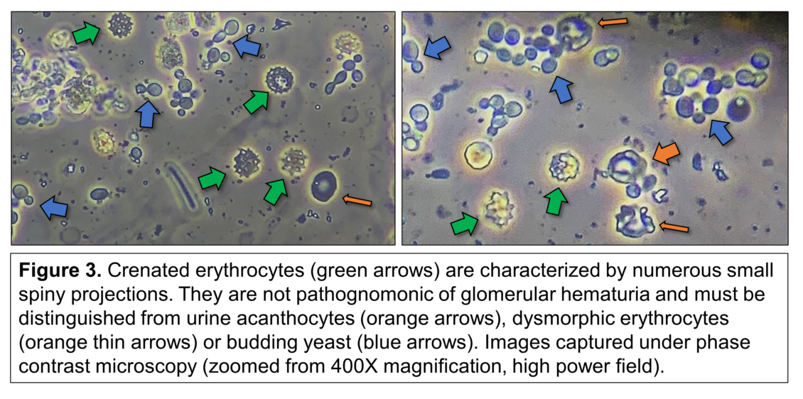 Urine Sediment of the Month: Dysmorphic Red Blood Cells, Blebs ...