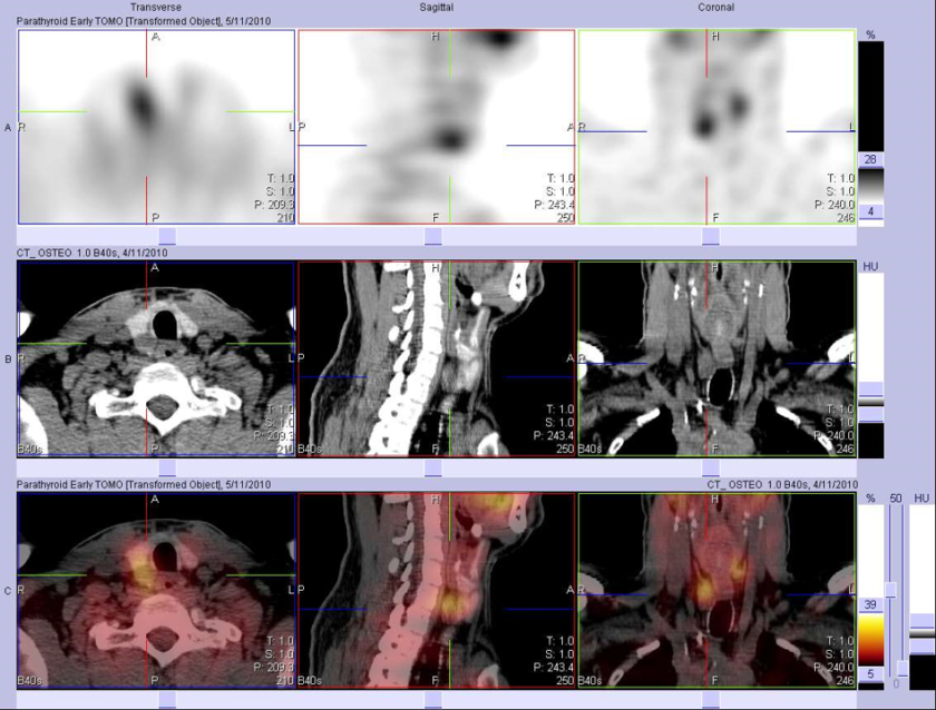 Parathyroid Imaging in Patients with Kidney Disease - Renal Fellow Network