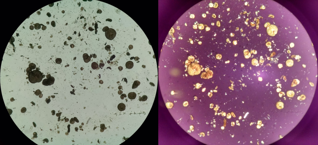Urine Sediment of the Month: Drugs & Crystalluria - Renal Fellow Network