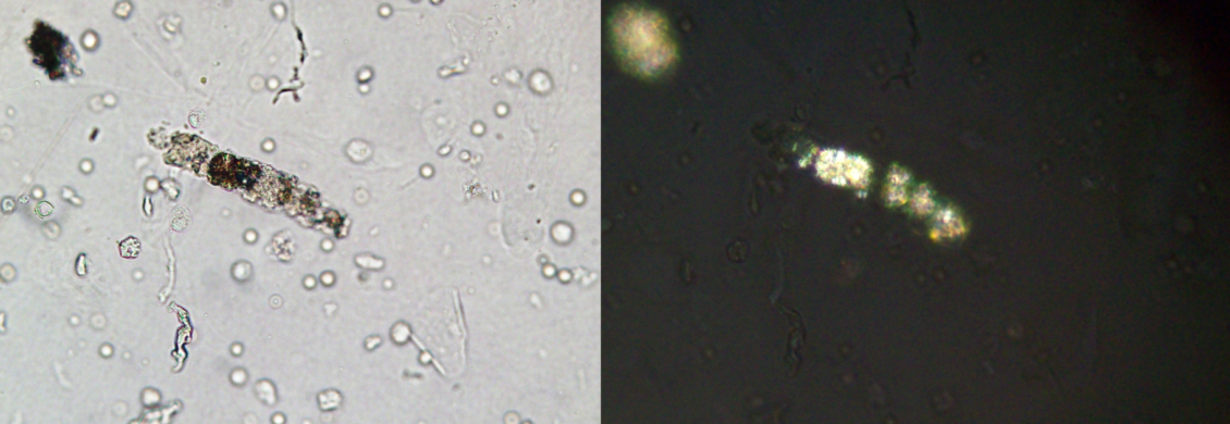 Urine Sediment of the Month: Drugs & Crystalluria - Renal Fellow Network