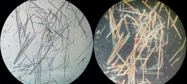 Urine Sediment Of The Month Drugs Crystalluria Renal Fellow Network