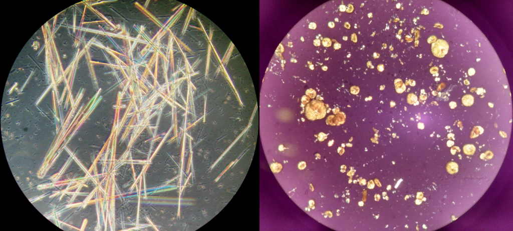 Urine Sediment of the Month: Drugs & Crystalluria - Renal Fellow Network