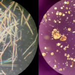 Urine Sediment of the Month: Drugs & Crystalluria - Renal Fellow Network