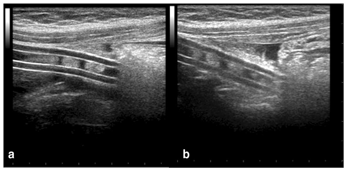 Bedside Ultrasonography of the Peritoneal Dialysis Catheter - Renal ...