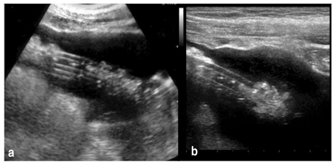 Bedside Ultrasonography of the Peritoneal Dialysis Catheter - Renal ...