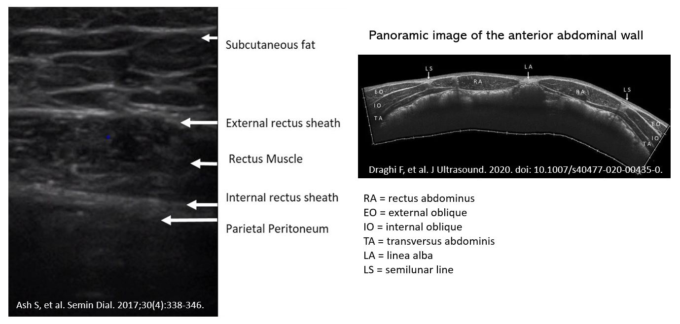 Bedside Ultrasonography of the Peritoneal Dialysis Catheter - Renal ...
